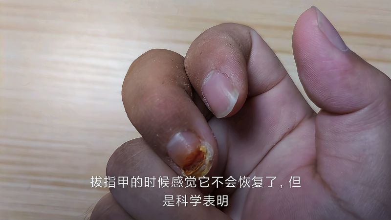 拔指甲之后还能长回来吗？小编的亲身经历带您见证科学健康养生健康常识好看视频